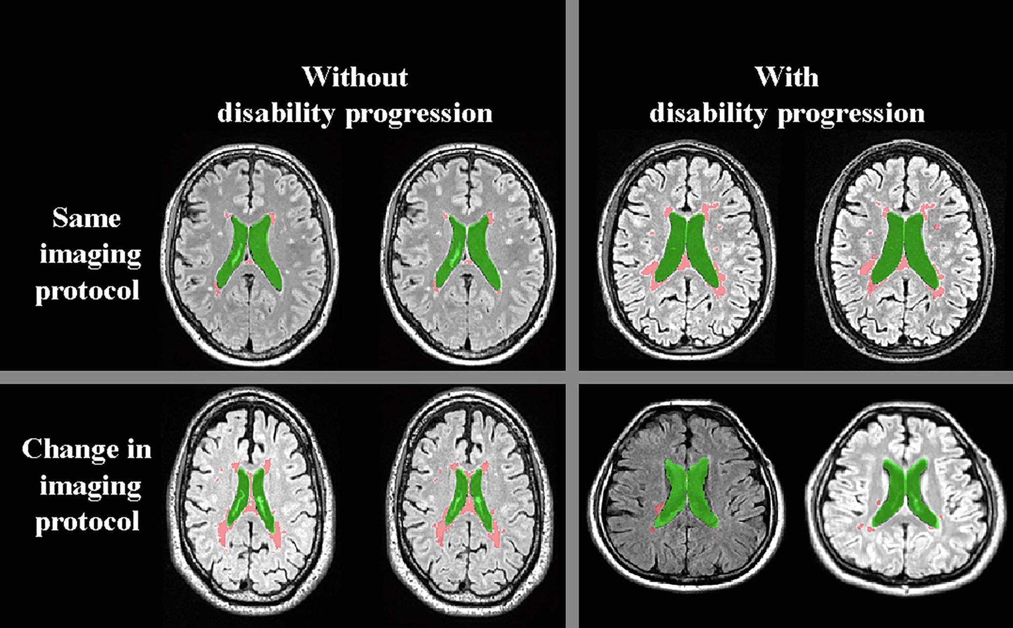 SNAC took part in the largest MRI-realword multiple sclerosis dataset ...